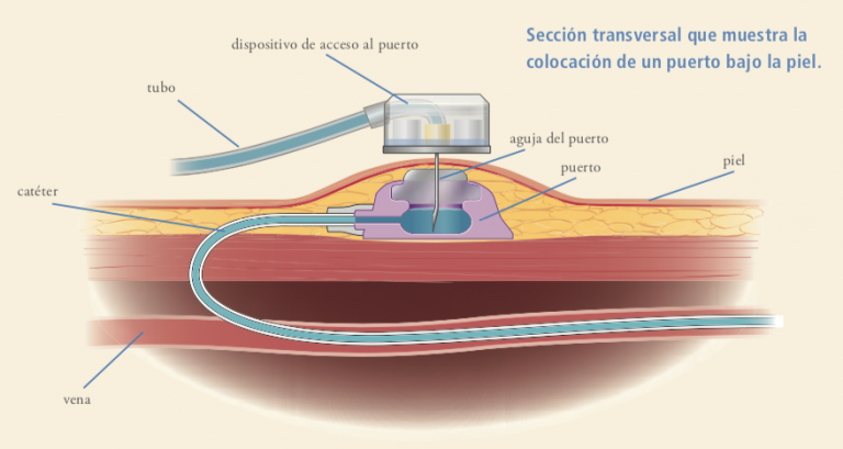 Cáteter implantable para quimioterapia